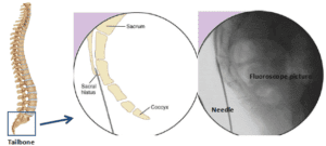 Caudal Epidural Block, Spine Care | Spine Sure Clinic