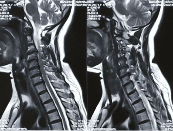Traditional Spine Surgery | Spine Sure Clinic