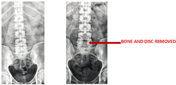 Laminectomy and Discectomy | Spine Sure Clinic