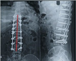 Spine Fracture Stabilization | Spine Sure Clinic